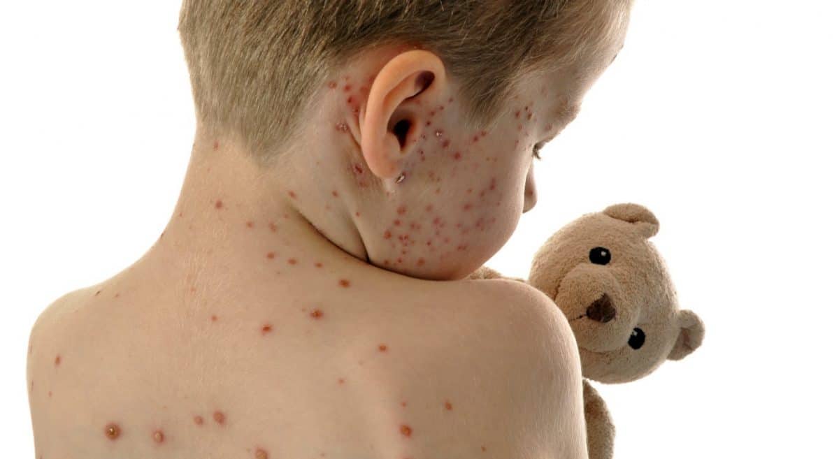 Sarampo: crianças entre 6 meses e um ano devem se vacinar